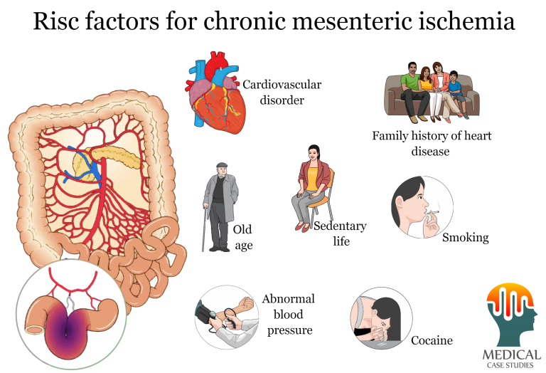 IBS and chronic mesenteric ischemia - Med Case Studies